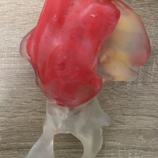 🦴 3D printed pelvic sarcoma・Free STL File for 3D printing・Cults