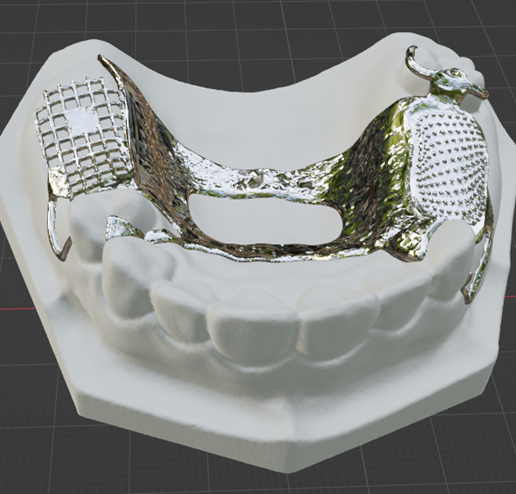 🦷 Prosthodontics Kennedy Class II Mod 1 Removable Partial Dentures ...