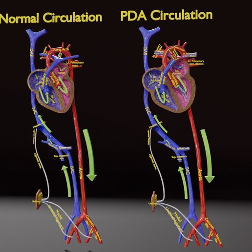 🩸 PDA Patent Ductus Arteriosus vs Normal blood circulation・ STL File ...