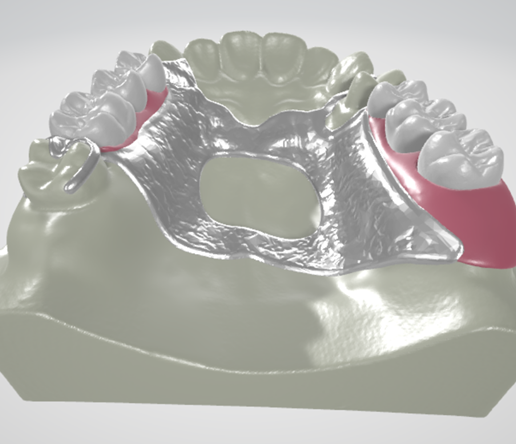 🦷 Prosthodontics Kennedy Class II Mod 1 Removable Partial Dentures ...