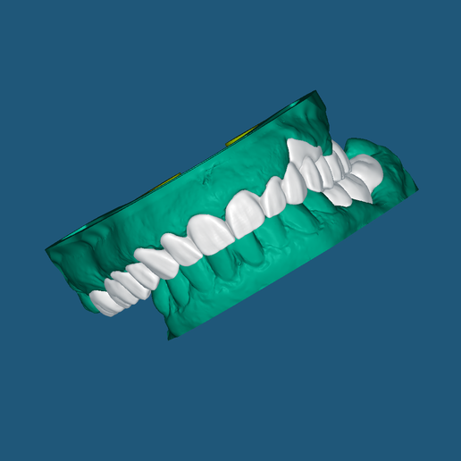 STL file exocad dental lab 🥼 ・3D print object to download・Cults