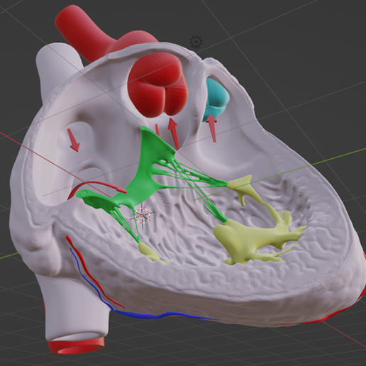 STL file Double Outlet Right Ventricle congenital heart disease ️ (OBJ ...