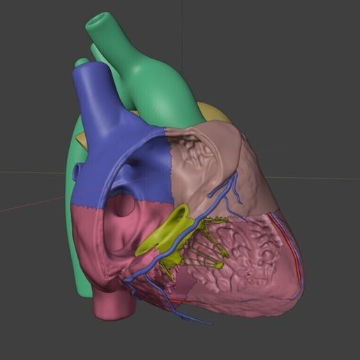 💜 3D Model of Heart with Atrial Septal Defect・ STL File for 3D printing ...