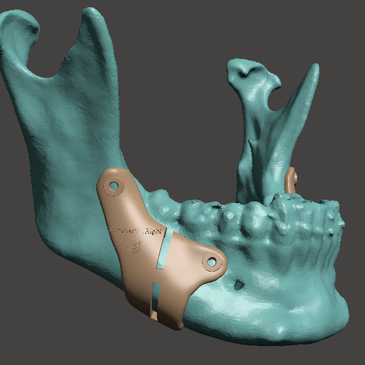 ⚕️ orthognathic surgery case with guides and segmentations・ STL File ...