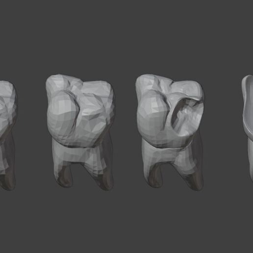 🦷 3D Model of Tooth Decay Progression - Dental Model・ STL File for 3D ...