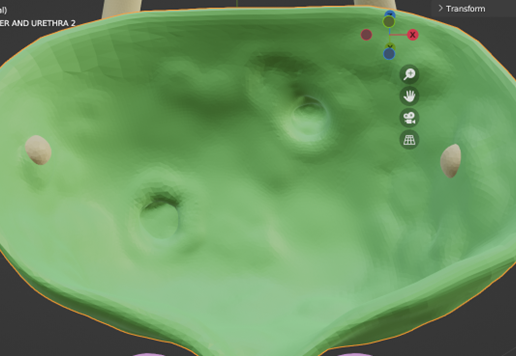 ♂️ 6 PARTS 3D Benign prostatic hyperplasia with complications ...