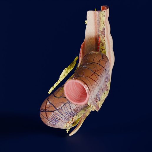 ⚕️ Intussusception intestine ileocolic obstruction・ STL File for 3D ...