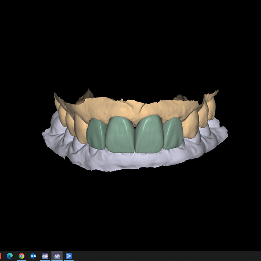 🎒 exocad diagnostic wax-up・Free STL File for 3D printing・Cults