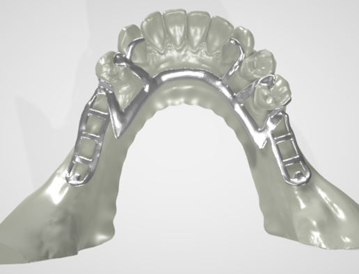 🎒 Prosthodontics Kennedy Class I Removable Partial Dentures (Lower Jaw ...
