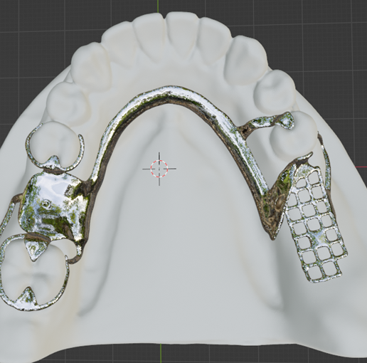 🦷 Prosthodontics Kennedy Class II Mod 1 Removable Partial Dentures ...