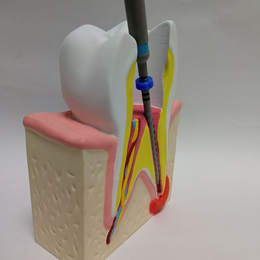 🦷 tooth with endodontic canal + endodontic file・ 3D File for 3D ...