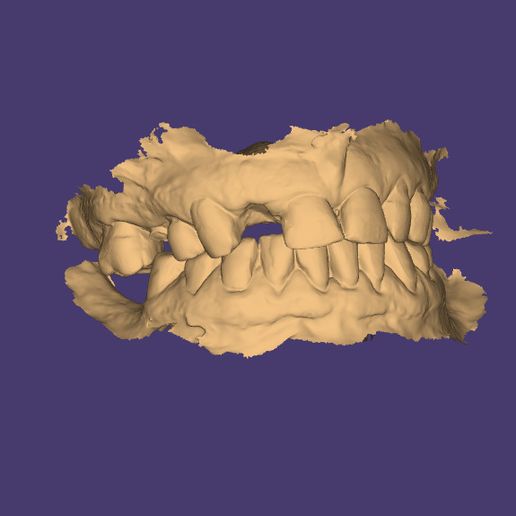 🧑‍🏫 INTRAORAL SCANS FOR RPD/FLIPPER - REAL PATIENTS, STUDY SCANS ...