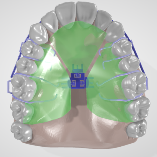 🦷 3 PARTS THREE-WAY SAGITAL RETAINER ON UPPER TEETH DENTAL APPLIANCE ...
