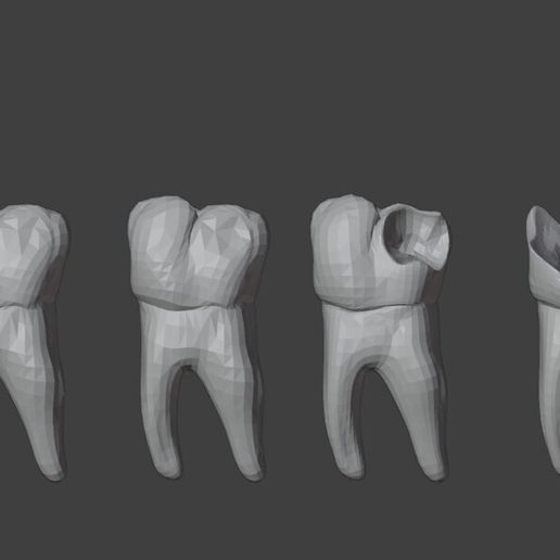 Archivo STL 3D Model of Tooth Decay Progression - Dental Model 🦷 (OBJ ...