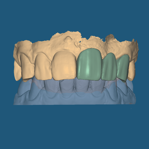 STL file exocad dental lab 🥼 ・3D print object to download・Cults
