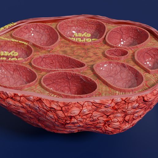 ⚕️ Polycystic Ovary Disease PCOD・ STL File for 3D printing・Cults