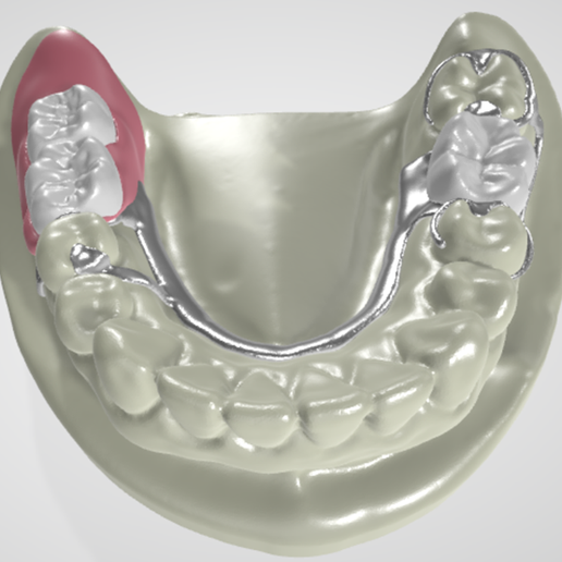 🦷 Prosthodontics Kennedy Class II Mod 1 Removable Partial Dentures ...