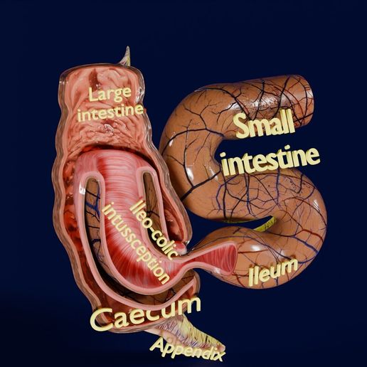 ⚕️ Intussusception intestine ileocolic obstruction・ STL File for 3D ...