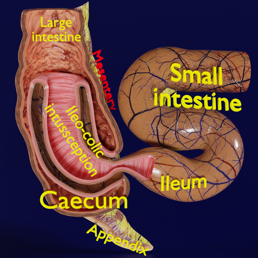 ⚕️ Intussusception intestine ileocolic obstruction・ STL File for 3D ...