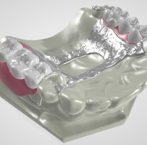 🦷 Prosthodontics Kennedy Class II Mod 1 Removable Partial Dentures ...