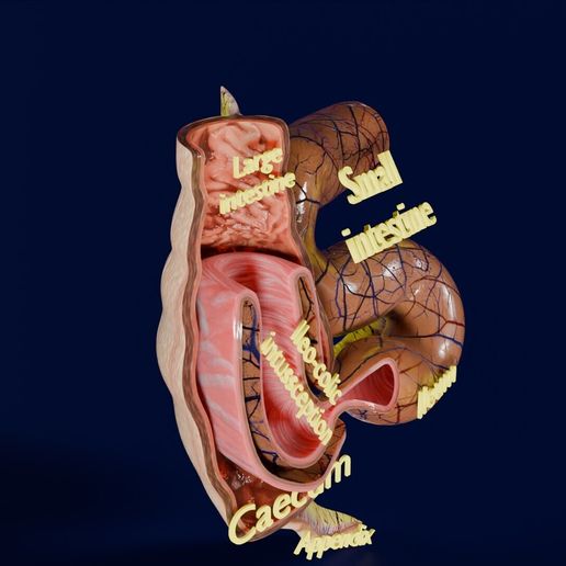 ⚕️ Intussusception intestine ileocolic obstruction・ STL File for 3D ...