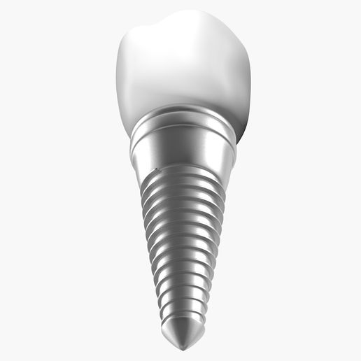 ⚕️ Dental Implant 3D Model – Medical Implantology Study Model ...