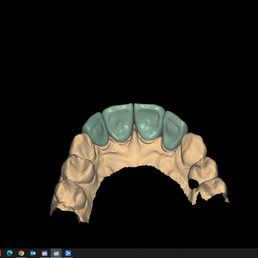 🎒 exocad diagnostic wax-up・Free STL File for 3D printing・Cults
