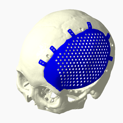 Archivo 3D CRANIAL IMPLANT WITH DEFECT 🦷 ・Diseño para descargar y ...