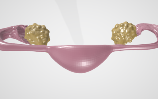 Archivo STL 3D Polycystic ovary syndrome model ♀️ (OBJ)・Modelo ...
