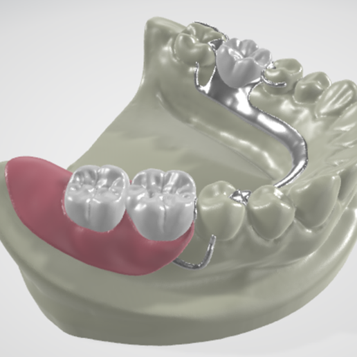 🦷 Prosthodontics Kennedy Class II Mod 1 Removable Partial Dentures ...