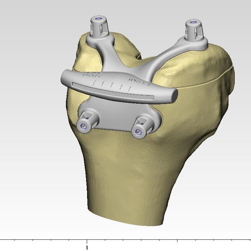 🩻 Knee joint prosthesis with guides (sample of individual prosthetics ...