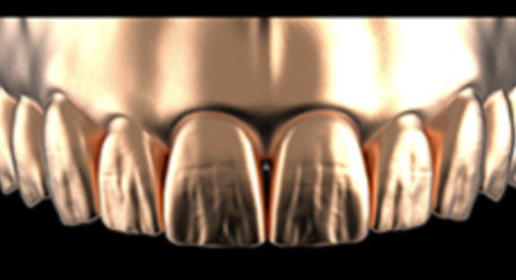 👑 The complete set of 36 'Expression' dental libraries - Exocad・ STL ...