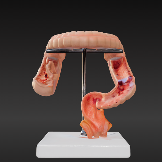 STL file 3D Model fo Intestinal Diseases 🎒 (OBJ)・3D printable model to ...