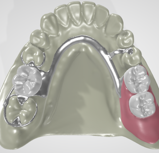 🦷 Prosthodontics Kennedy Class II Mod 1 Removable Partial Dentures Lower Jaw・ STL File for 3D ...