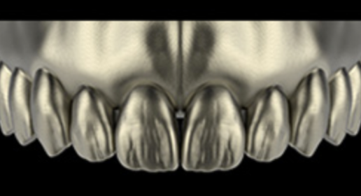 👑 The complete set of 36 'Expression' dental libraries - Exocad・ STL ...