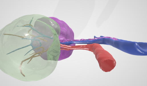 STL file 3D Kidney cancer and renal vein thrombosis ♋ (OBJ)・Model to ...