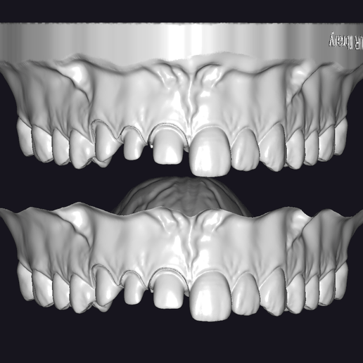🦷 Restorative and training. Upper_Crowns 11-12-13 + Model for print ...