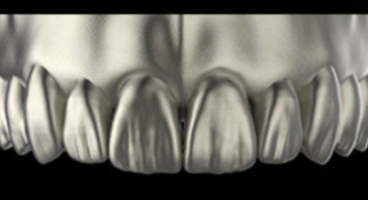 👑 The complete set of 36 'Expression' dental libraries - Exocad・ STL ...