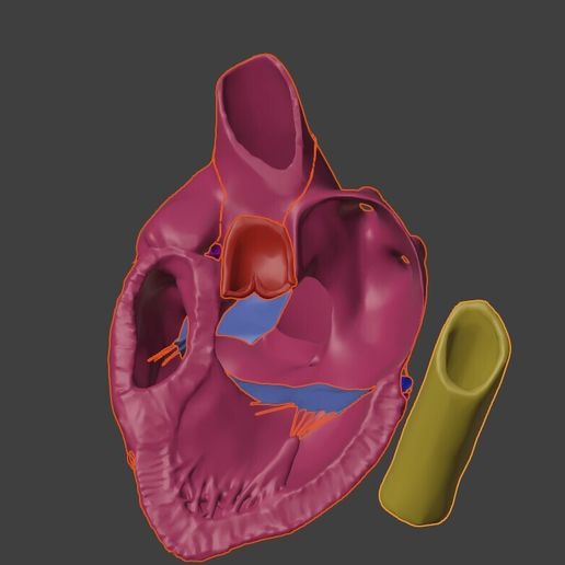 💜 3D Model of Heart with Atrioventricular Septal Defect - PSLAX・ STL ...