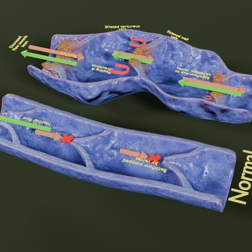 ⚕️ Varicose vein valve・ STL File for 3D printing・Cults