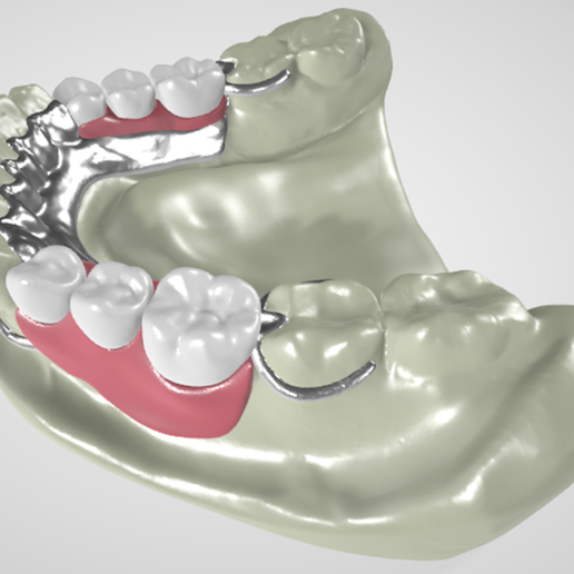 Archivo STL Prosthodontics Kennedy Class III Mod 1 Removable Partial ...