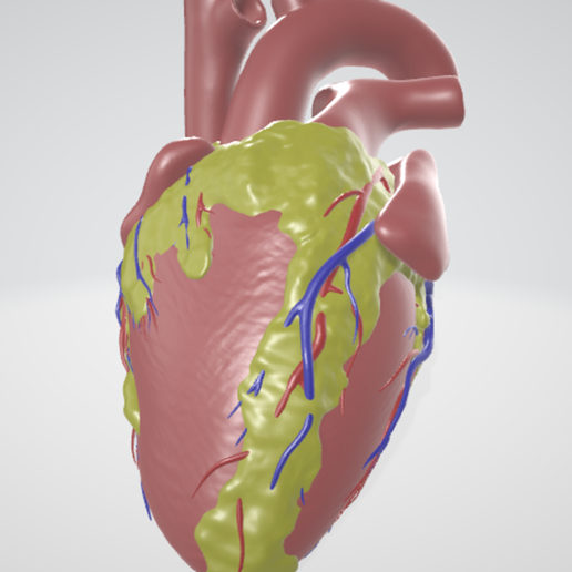 💜 Detailed 3D Model of an Obese Heart – "FATTY HEART"・ STL File for 3D ...