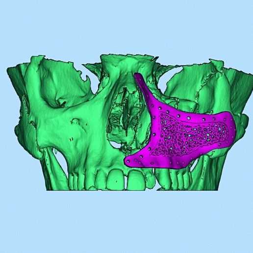 🩻 3d printed maxilla implants in facial rehabilitation・ STL File for 3D ...