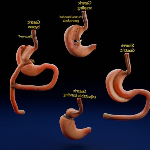⚕️ Bariatric Surgery Types・ STL File for 3D printing・Cults