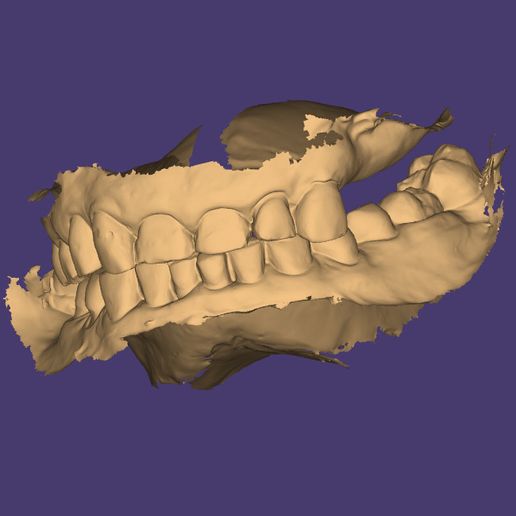 🧑‍🏫 INTRAORAL SCANS FOR RPD/FLIPPER - REAL PATIENTS, STUDY SCANS ...