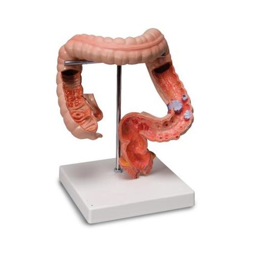 🎒 3D Model fo Intestinal Diseases・ STL File for 3D printing・Cults