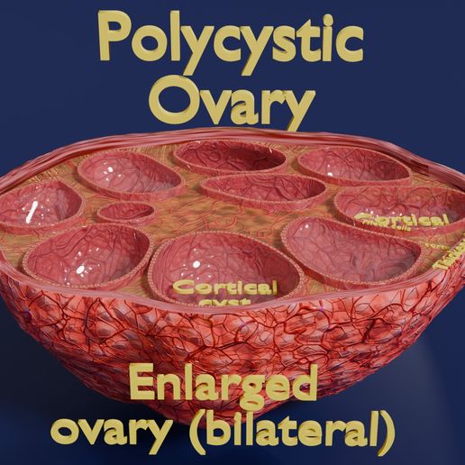 ⚕️ Polycystic Ovary Disease PCOD・ STL File for 3D printing・Cults