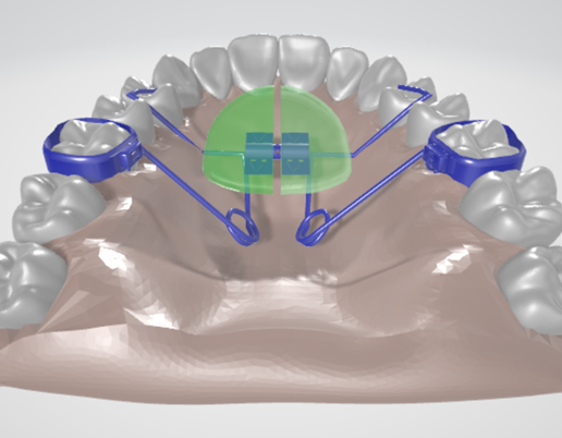 🦷 3 PARTS PENDEX DISTALIZER ON UPPER TEETH DENTAL APPLIANCE・ STL File ...