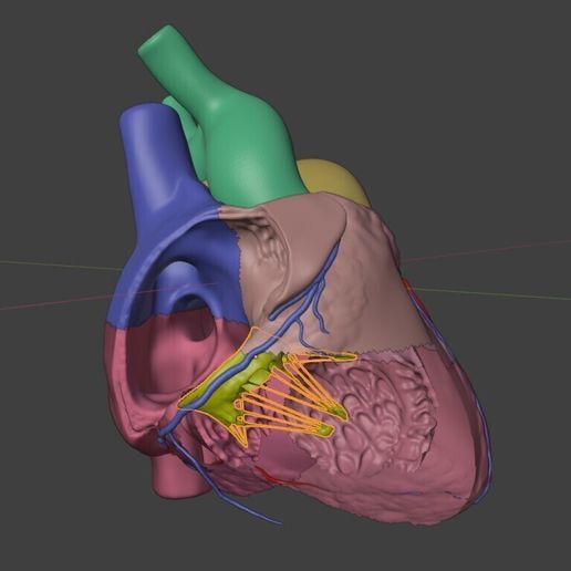 💜 3D Model of Heart with Atrial Septal Defect・ STL File for 3D printing ...