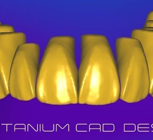 🦷 Titanium Cad Library For exocad・ 3D File for 3D printing・Cults